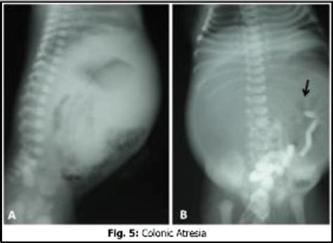 A Plain X Ray Erect Abdomen Shows A Grossly Dilated Ileal Loop With