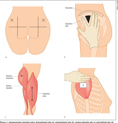 Ventrogluteal Injection Landmarks