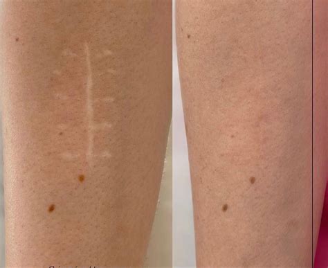 Skin Colored Tattoos To Cover Scars Artofit