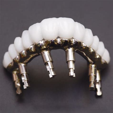 Bio Infinitum Launches Implant Bridge In Titanium