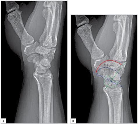 Scaphoid X Ray Angle