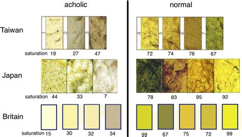 Pale Stools Differential Diagnosis At Malik Keck Blog