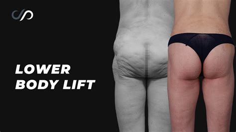 Amazing 8 Day Body Lift Results That Will Blow Your Mind Youtube