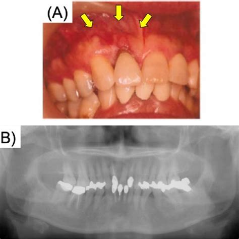Findings After Partial Resection Of The Maxilla A Intraoral Findings