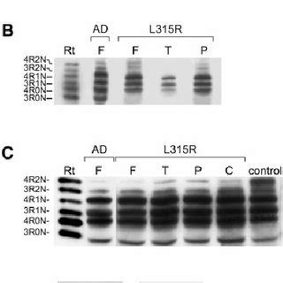 Sarkosyl Insoluble Tau And Soluble Tau In Cerebral Cortex From Patient