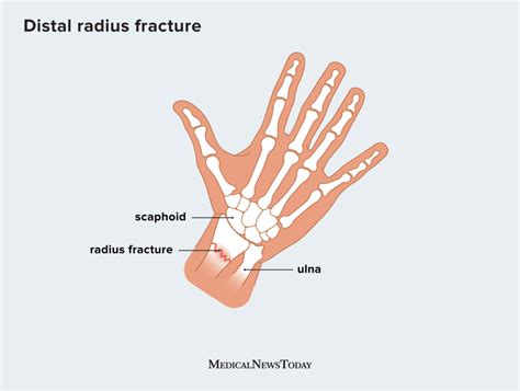Ulna Wrist Fracture Distal Radial Fracture Fife Virtual Hand