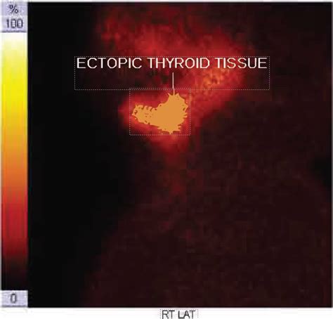 Lingual Thyroid Best Multispeciality Hospital In Mumbai India
