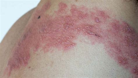 Shingles Herpes Zoster Causes Symptoms And Treatment