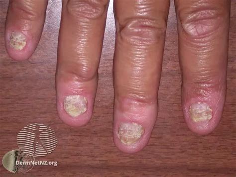 Managing Psoriasis Of The Hands Palms Knuckles And Fingers Mypsoriasisteam