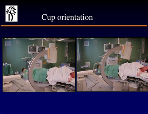 Ppt Dislocation After Total Hip Replacement Etiology And Management