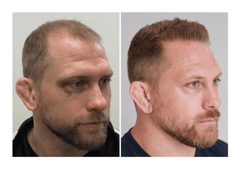 Hair Transplant Beforeafter Results For Men Bosley Hair Transplant