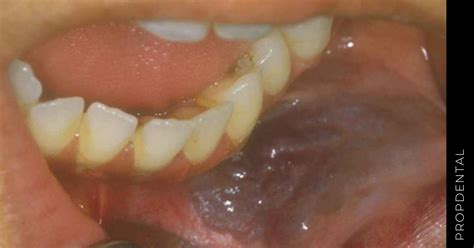 Hemangioma Dental Tratamiento Hemangiomas