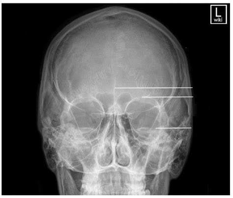 Diagram Of Skull Xray Ap Quizlet