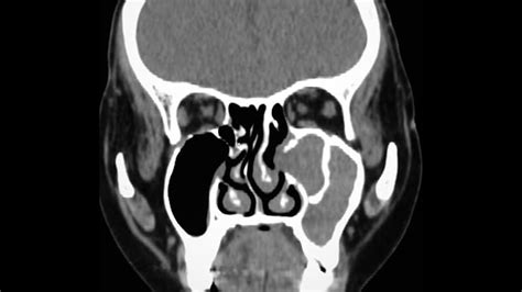 Sinus Infection Brain Tumor