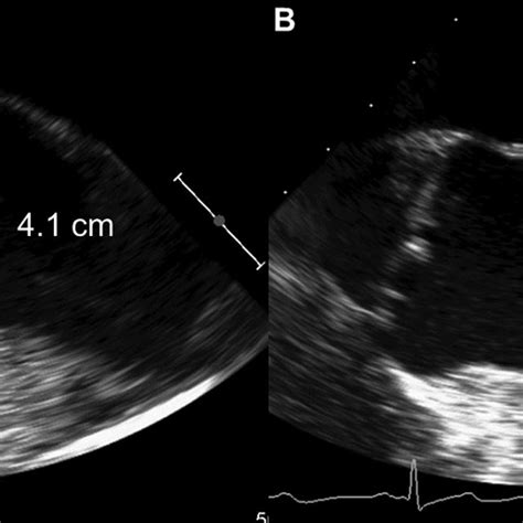 Tee Image Of The Aortic Valve In Short Axis View Demonstrating Four