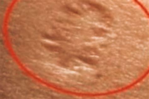 The Story Behind The Small Scar A Mark Of Victory Over Smallpox T Hch