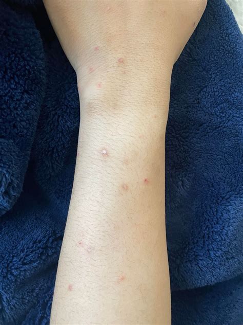 Bug Bite Scabsscars Rbugbites
