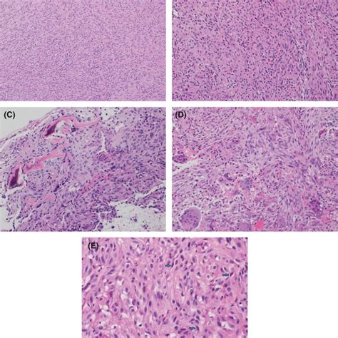 A The Tumor Cells Demonstrate Immunoreactivity For Cd31 Antibody