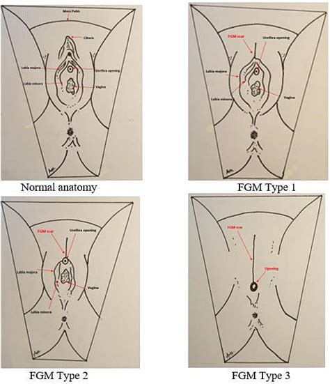 Types Of Female Circumcision