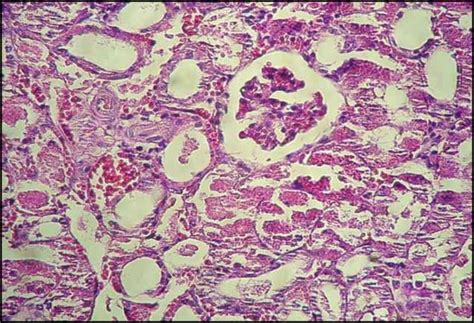 Glomerular Atrophy And Acute Tubular Necrosis Of Renal Section In Gm Download Scientific