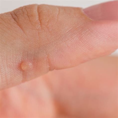 Warts London Wart Clinic