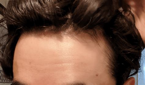 Am I Thinning Balding R Malehairadvice