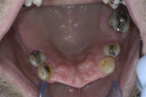 Gingivectomy Cost A Comprehensive Guide To Procedure Pricing And Insurance Coverage Chaztin