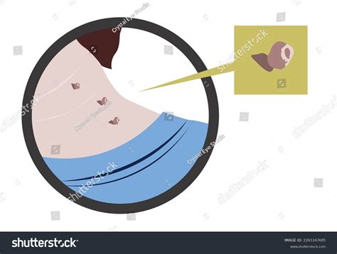 Fibroepithelial Polyp Over 1 Royalty Free Licensable Stock