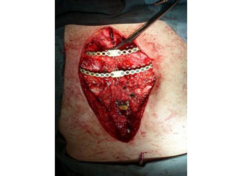 Sternum Plating System