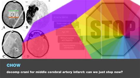 Decompressive Craniectomy In Middle Cerebral Artery Infarction Coda