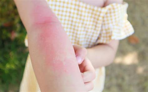 Kenali Penyebab Dan Cara Mengatasi Rinitis Alergi Prosix