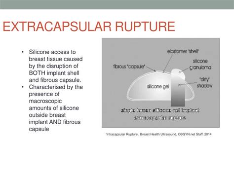Exams And Me Breast Implant Rupture Snowstorm Sign