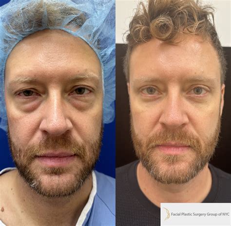 Upper Blepharoplasty Before And After Photos