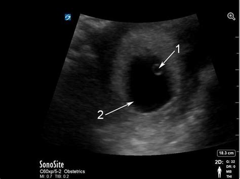 Pregnancy Section 3 Chapter 2 Lesson 8 Endovaginal Scan