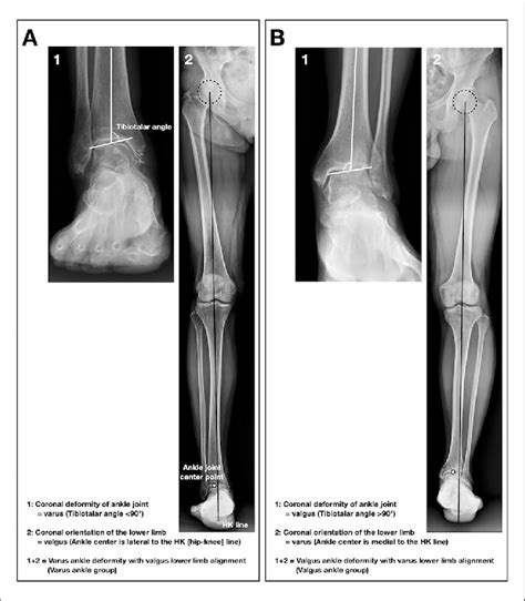 Determination Of Orientations Of Ankle Deformity And Lower Limb