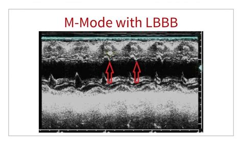 Echocardiography In The Presence Of Left Bundle Branch Block Cardioserv