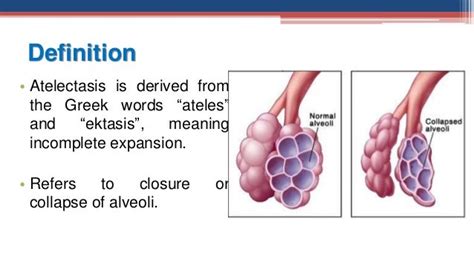 Atelectasis Alveoli