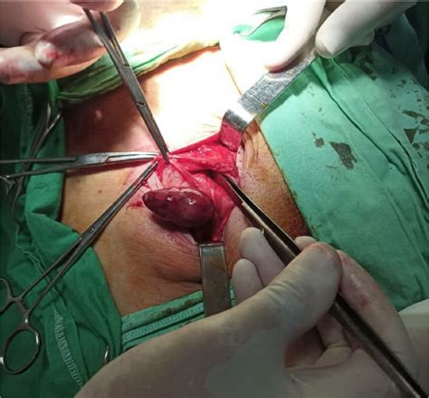 A Femoral Hernia Containing A Necrotic Top Vermiform Appendix