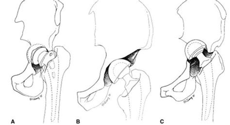 Classifications Used In Total Hip Arthroplasty Intechopen