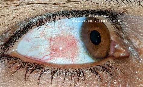 Optoera Nodular Episcleritis 🧿 Episcleritis Is A Benign Self