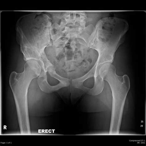 Periacetabular Osteotomy Pao Nigel Kiely