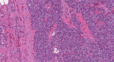 Non Invasive Follicular Thyroid Neoplasm With Papillary Like Nuclear