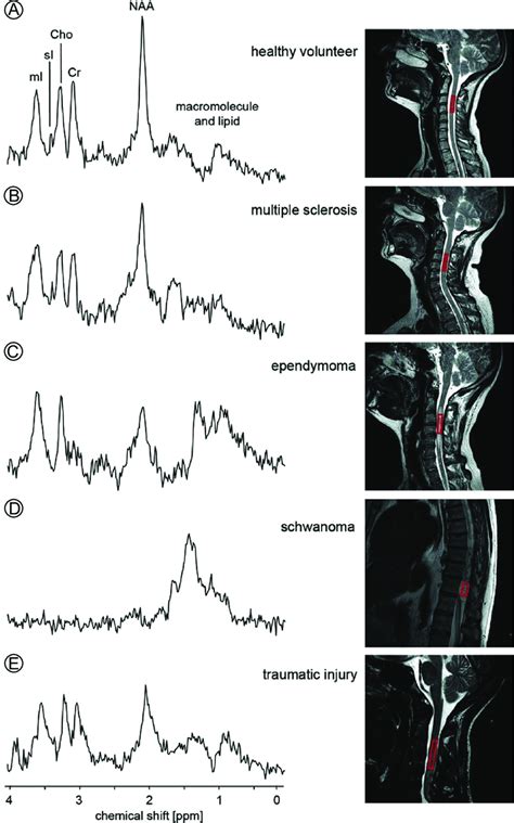 Metabolic Fingerprint Of Different Pathologies In The Spinal Cord