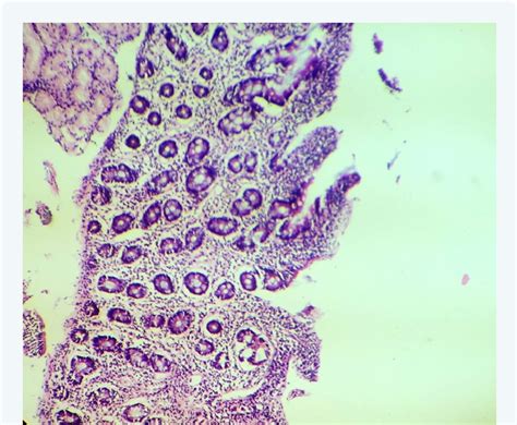 Duodenal Biopsy Showing Stage Iii Marsh Classification Download Scientific Diagram