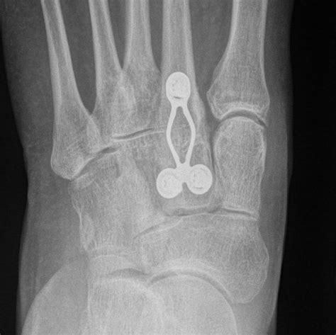 Midfoot And Hindfoot Fusion Dr Ben Beamond Adelaide