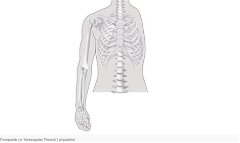 Levels Of Amputation