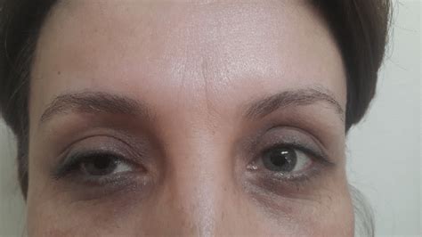 Levator Palpebrae Superioris Botox