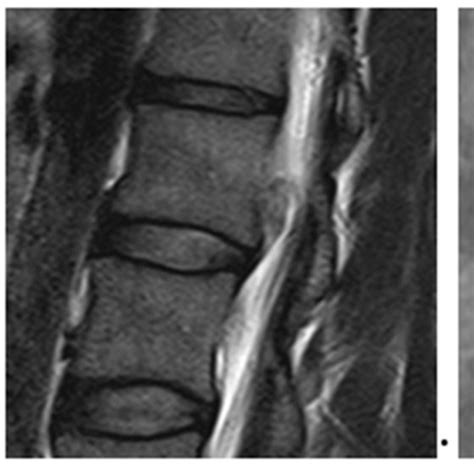 Classification Of Upward Ruptured Disc Migration A Type A Upward