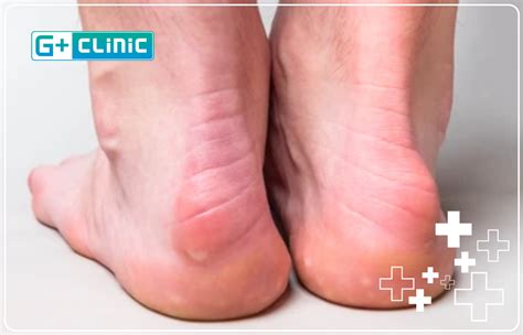 Bone Deformity Correction In Turkey G Clinic