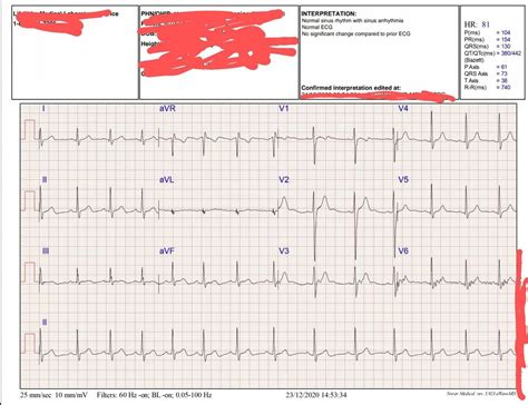 Normal Sinus Ekg What Defines A True Normal Sinus Rhythm On A 12 Lead